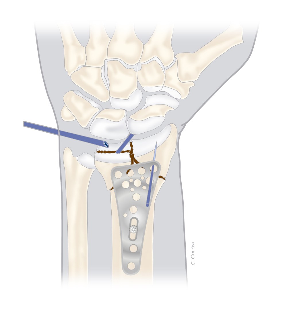 Fractura de Radio Distal o de Colles | Blog | Fabio Tandioy