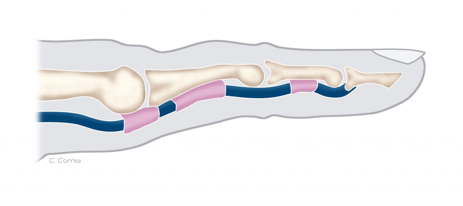 Dedo en gatillo | Fracturas de Cubito Proximal | Blog | Fabio Tandioy
