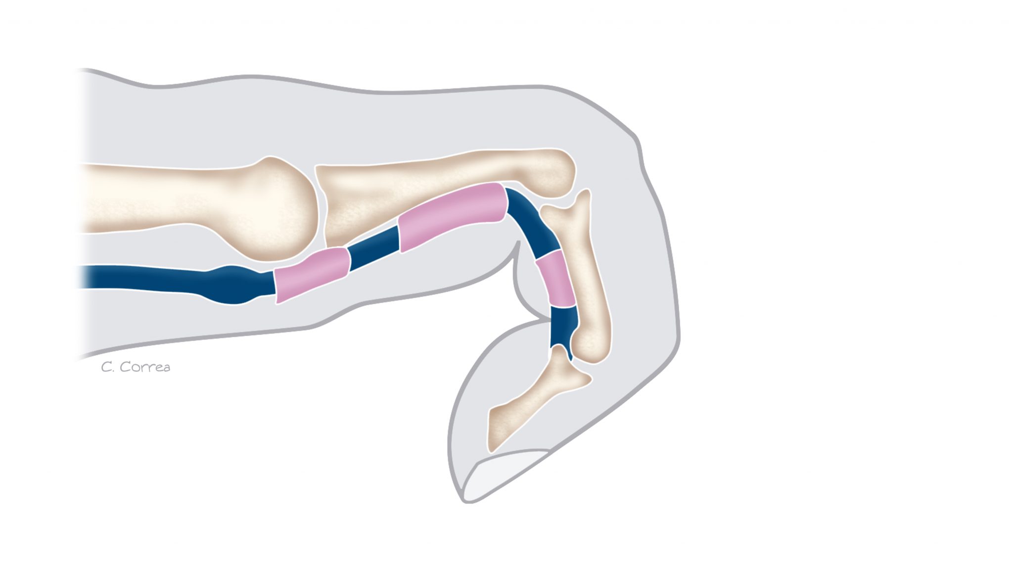 Dedo en gatillo | Fracturas de Cubito Proximal | Blog | Fabio Tandioy