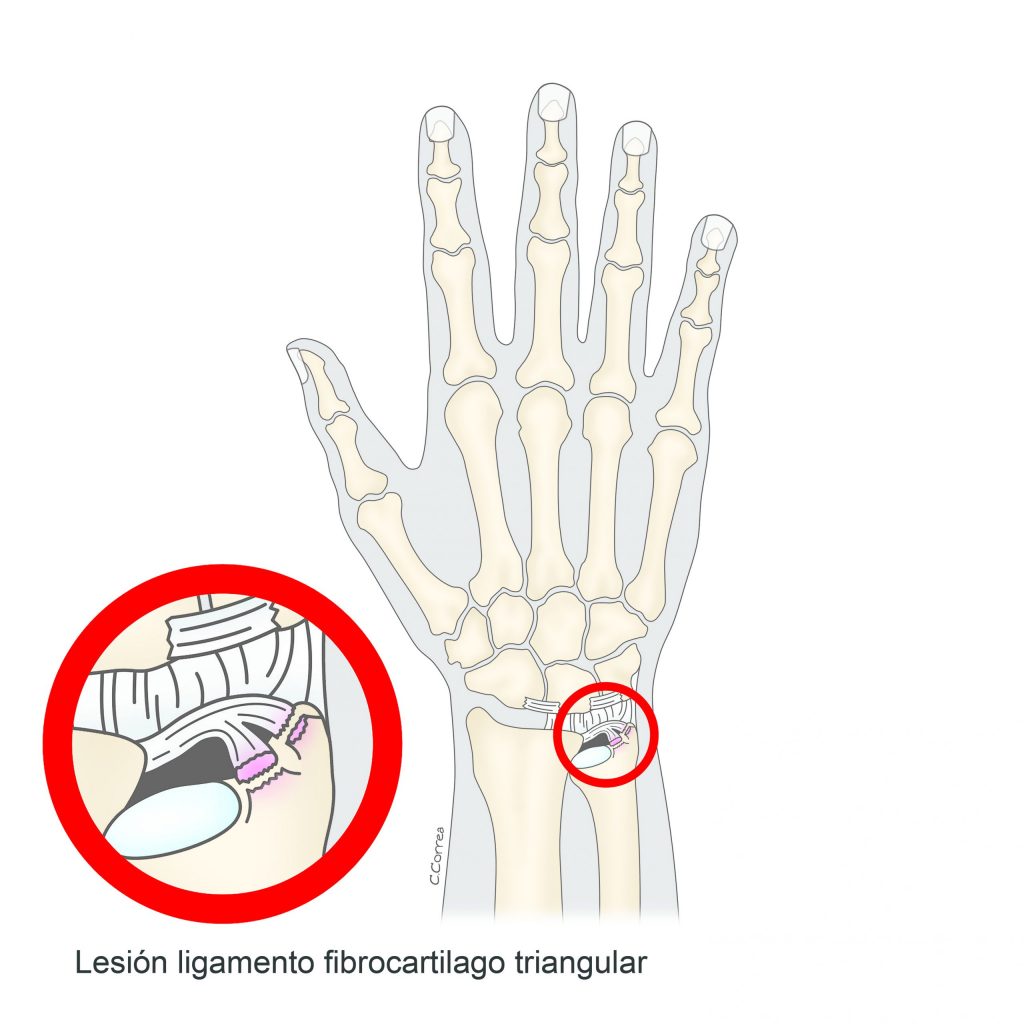 Lesión de fibrocartílago triangular - Blog - Fabio Tandioy